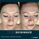 Skinwave Aqua Treatment - Advanced Dermatology and Skin Care Center ...