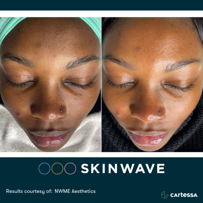 Skinwave Aqua Treatment - Advanced Dermatology and Skin Care Center ...