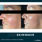 Skinwave Aqua Treatment - Advanced Dermatology and Skin Care Center ...