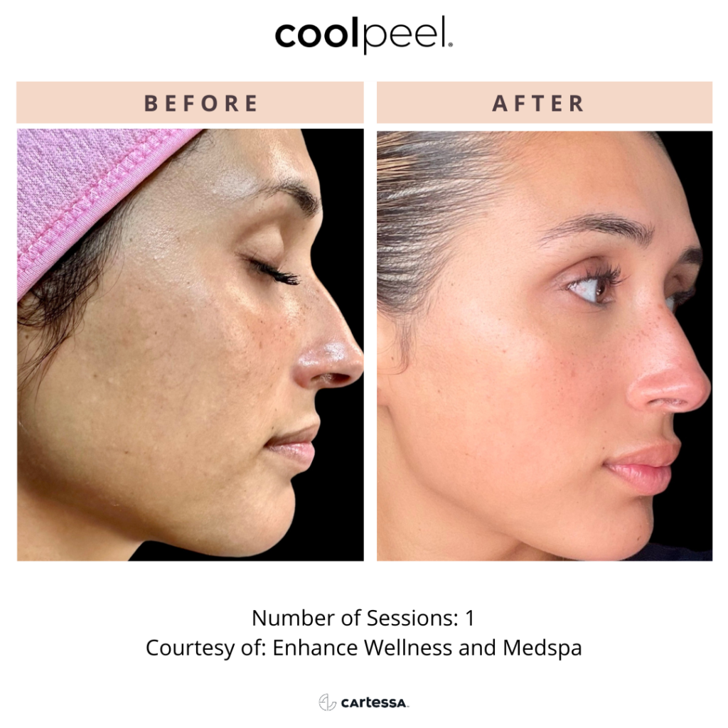 Cartessa Tetra & Coolpeel CO2 | Advanced Dermatology Centre